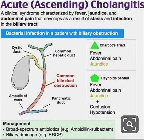 Acute Cholangitis Medizzy