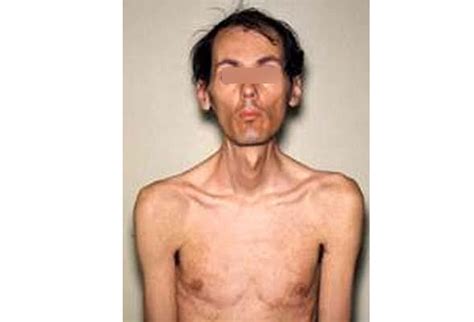 Myopathies Muscling Your Way To The Diagnosis