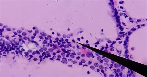 Science Non Spontaneous Thyroid Goiter Album On Imgur