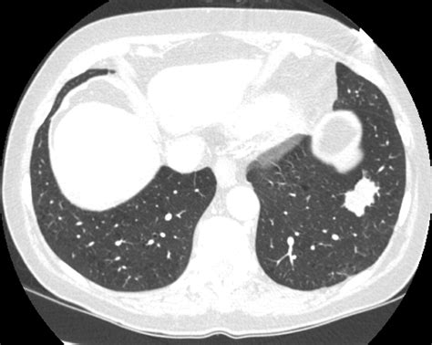 Thoracoscopic Basilar Segmentectomy Seminars In Thoracic And Cardiovascular Surgery