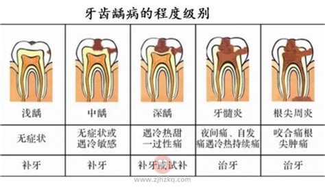 龋齿各级别程度图片 杭城看牙记