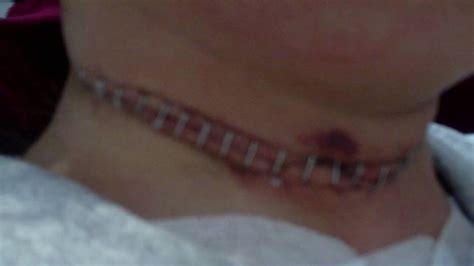 Thyroid Surgery Youtube