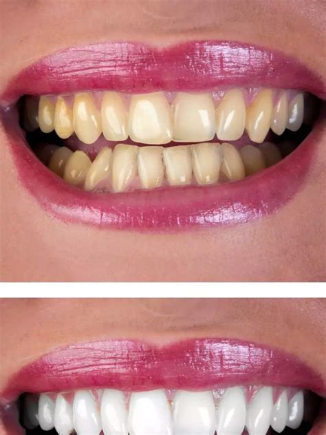 పసుపు దంతాలను తెల్లగా మార్చే ఇంటి చిట్కాలు Telugusamayam