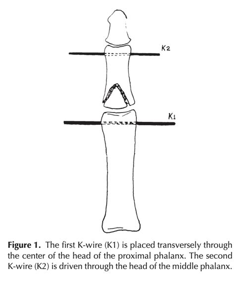 Dynamic Intradigital External Fixation