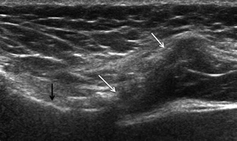 Xiphoid Process Protrusion