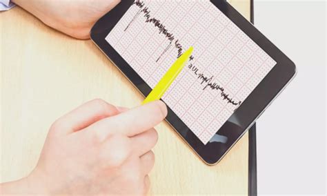 Easy To Use Ecg Algorithm Can Predict Coronary Occlusion Site In Stemi