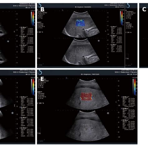 Transient Elastography Fibroscan ® A For The Evaluation Of Normal Download Scientific
