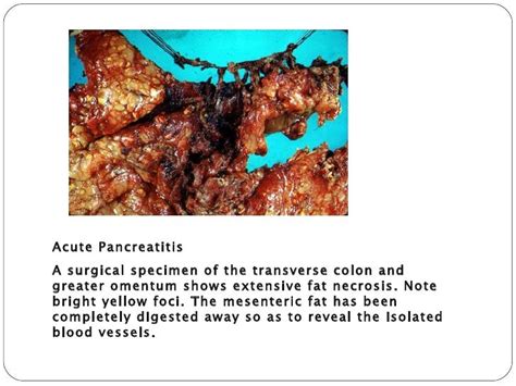 Acute Pancreatitis
