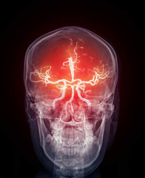 CT Angiography CTA Scan Of The Brain Stock Image Image Of Clear Human