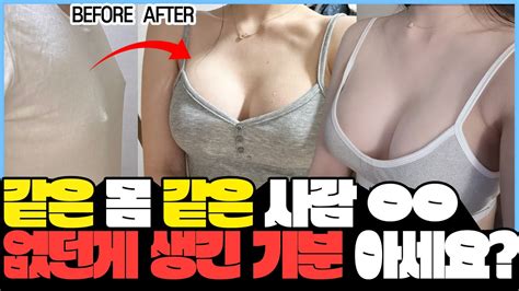 [가슴수술] 없던게 생기니까 너무 좋아💖 1년후 비포 애프터 리얼후기 버블tv Youtube