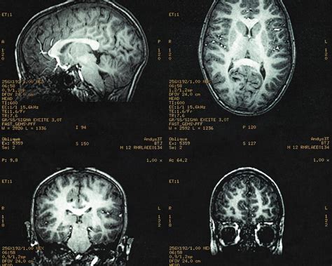 Early Multiple Sclerosis Mri