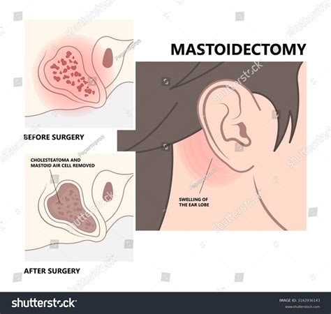 Mastoidectomy Types