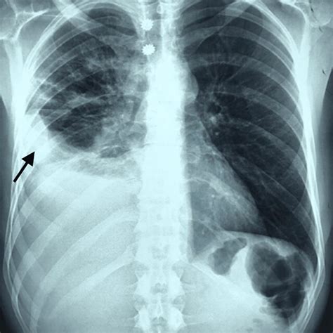 Chest X Ray Showing Right Unilateral Pleural Effusion Black Arrow