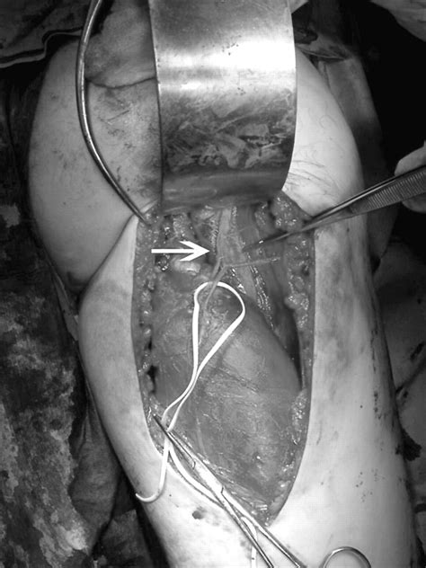 Proximal Hamstring Tendon Rupture