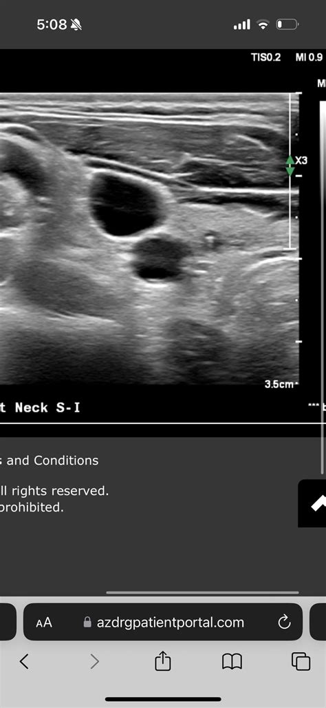 Thyroid Ultrasound Rradiology