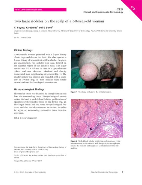Pdf Two Large Nodules On The Scalp Of A 60 Year Old Woman