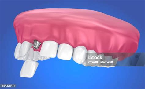 치아 임 플 란 트와 크라운 설치 과정 의학적으로 정확한 3d 그림 건강관리와 의술에 대한 스톡 사진 및 기타 이미지 건강관리와 의술 드릴 미국 Istock