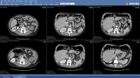 Sectra Lesion Tracking Sectra Medical