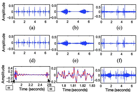 Bss Of Cardiac And Respiratory Sounds Using The Proposed Semisupervised