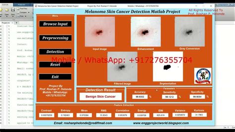 Melanoma Skin Cancer Detection Image Processing Using Matlab Final