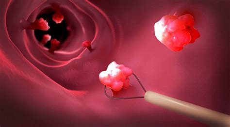 Can An Artificial Intelligence Device Increase Polyp Detection During Colonoscopy On Medicine