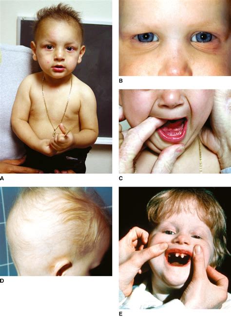 Ectodermal Dysplasia Syndrome