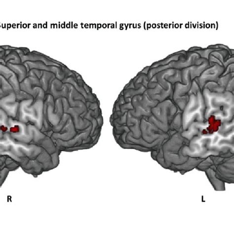Results From The Voxel To Voxel Analysis Showing Areas Of Highest