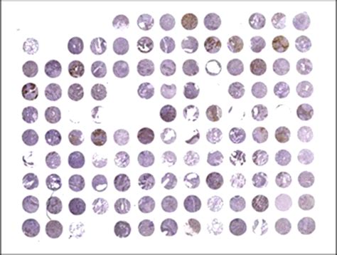 Ubch10 Overexpression In Human Lung Carcinomas And Its Correlation With