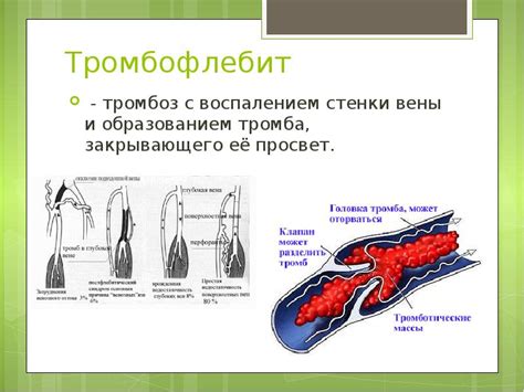 Тромбофлебит