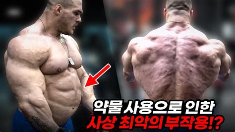 극도로 약물을 투여한 보디빌더의 끔찍한 결말 복부팽창 팔룸보이즘 최악의 복부 문제 Youtube