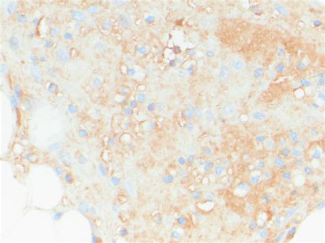 IgG Immunohistochemistry On Sclerosing Peritoneal Lesion Download