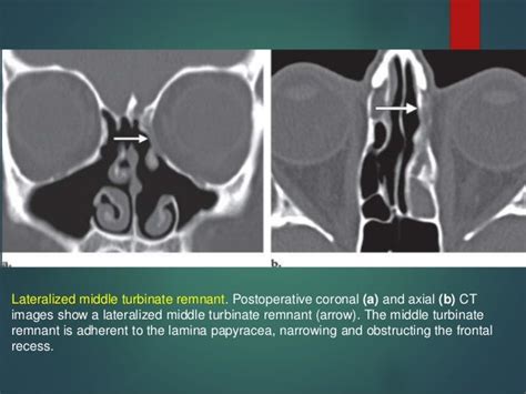 Failed Fess Spectrum Of Ct Findings In The Frontal Recess