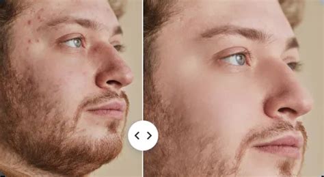 Видалення Акне з Фото Онлайн Редагування Чистої Шкіри Snapedit