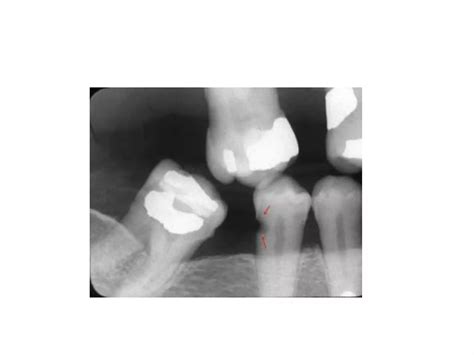 Dental Caries Classificationppt