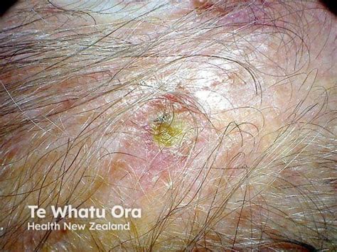 Erosive Pustular Dermatosis Of The Scalp Image