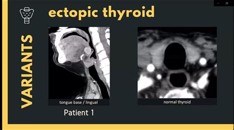 Ectopic Thyroid