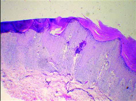 Histologic View Of The Lesion Hande 20× Download Scientific Diagram