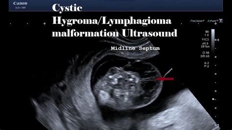 Cystic Hygroma Lymphangioma Malformation Ultrasound Case Youtube