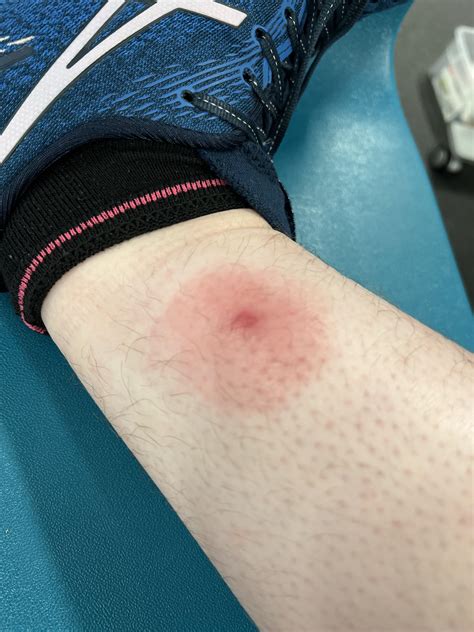 Mrsa Staph Aureus Infection Versus Lymes Disease R