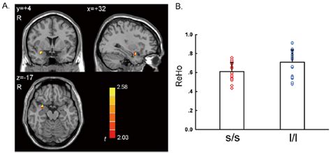 Significant Higher Reho In The Right Amygdala In Ll Group Than Ss