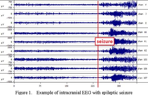 Figure 1 From Seizure Onset Zone Detection And Localization In Ieeg Using Dtf Semantic Scholar