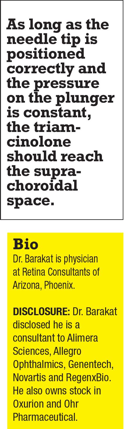 The Hands On Technique For Suprachoroidal Injection