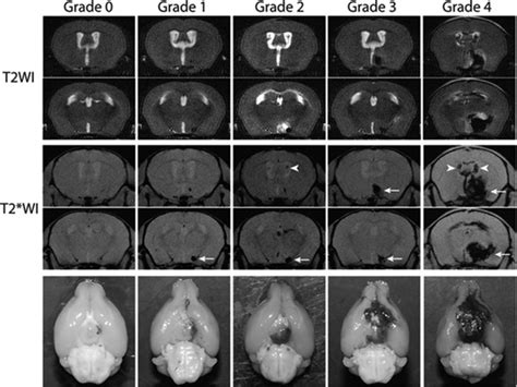 Intraventricular Hemorrhage Grades