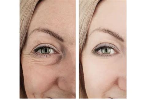 Under Eye Filler Richmond Hill Under Eye Filler Before And After