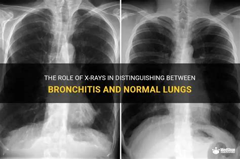 Can You See Bronchitis In A Chest X Ray At Sarah Fox Blog