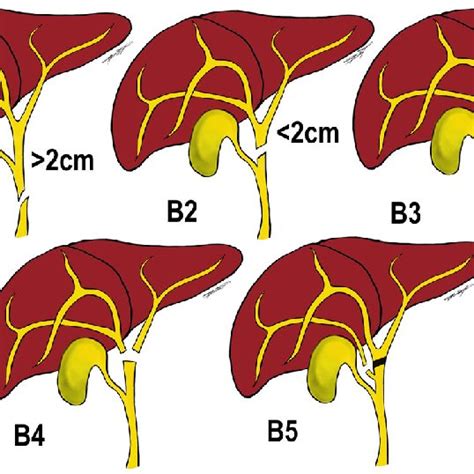 Percutaneous Transhepatic Cholangiogram Ptc Performed 10 Days Download Scientific Diagram