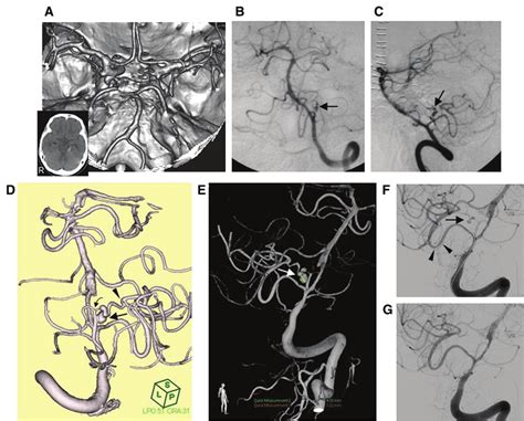 Case 2 A The Initial Ct Scan Inset And 3d Cta Showed Sah Limited Download Scientific