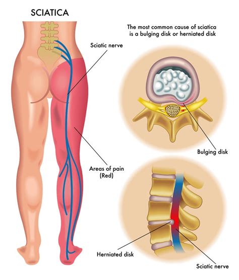 Inflammation Of The Sciatic Nerve—sciatica Sierra Neurosurgery Group