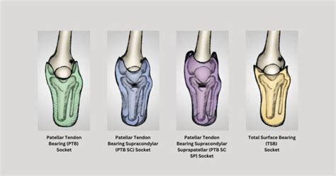 Prosthetic Socket Explained Types Process Solutions And More