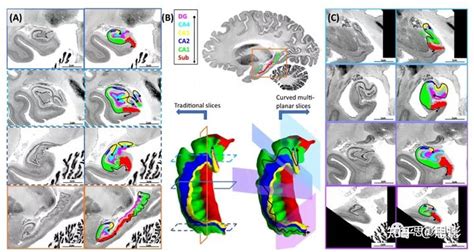 基于表面形态的海马亚区分割海马分区 Csdn博客